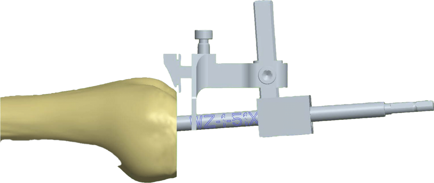 Symmetric Total Knee - Alliant Biotech