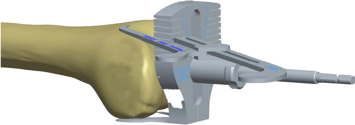 Symmetric Total Knee - Alliant Biotech
