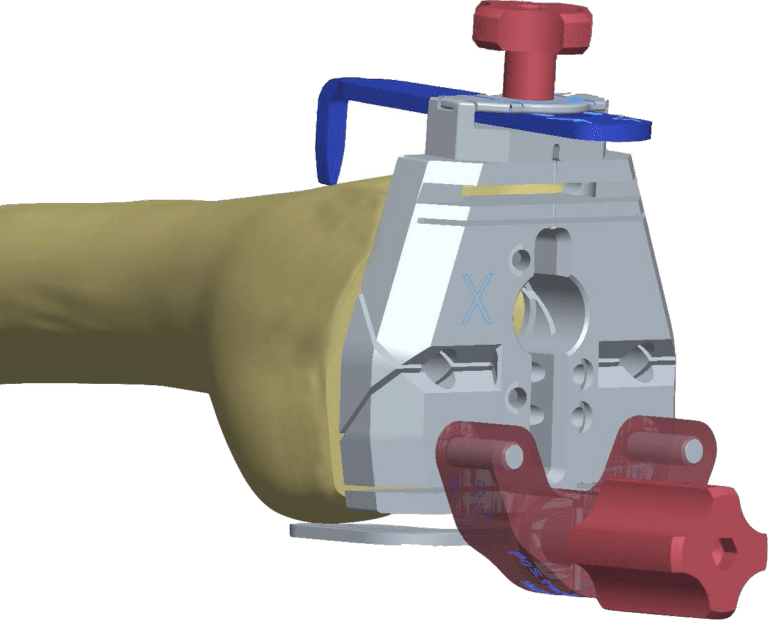 Symmetric Total Knee - Alliant Biotech