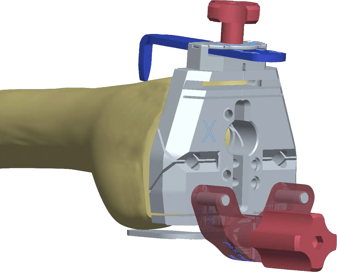 Symmetric Total Knee - Alliant Biotech