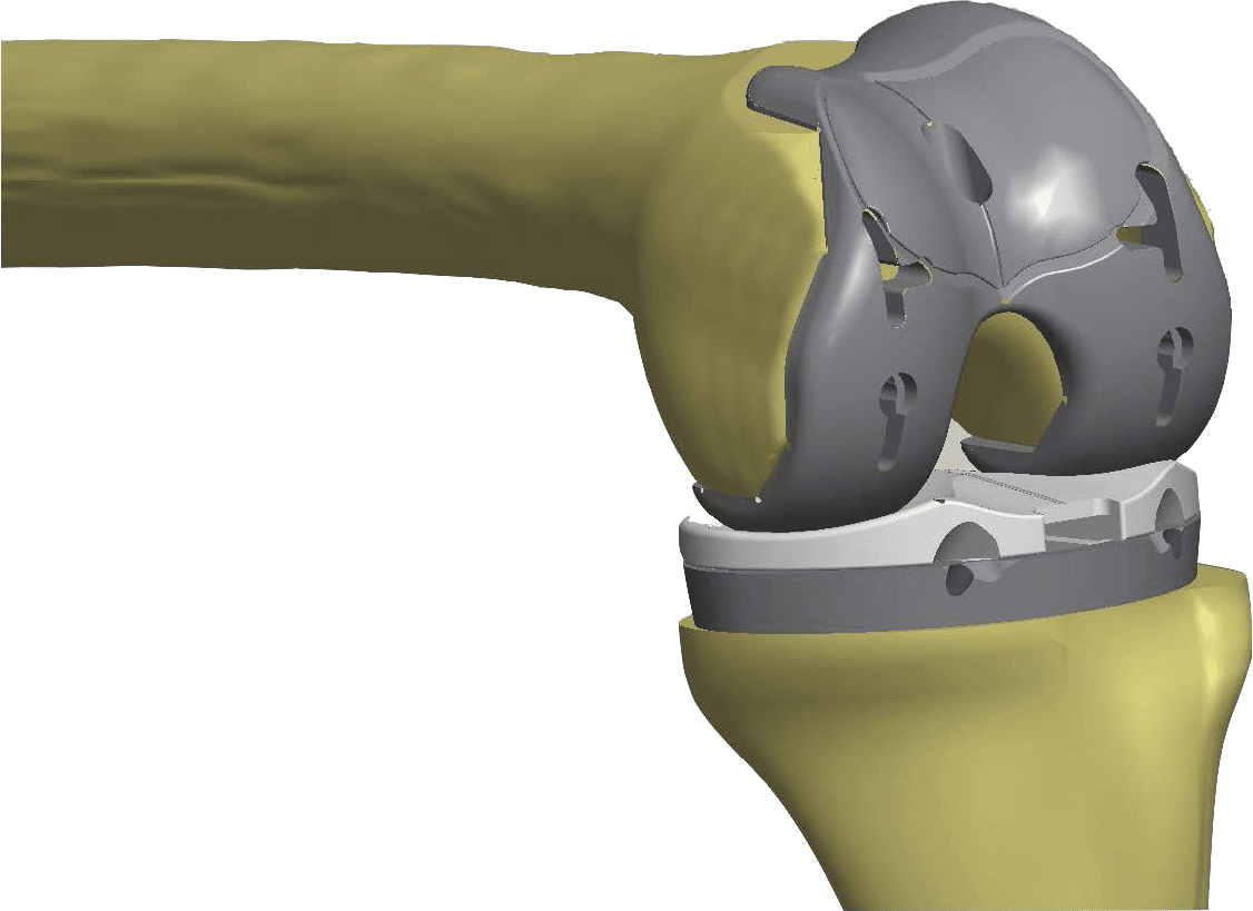 Symmetric Total Knee - Alliant Biotech